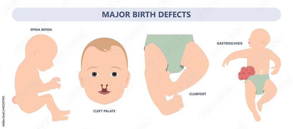 Vecteur Stock foot deformities infant turned inward upward birth baby ...