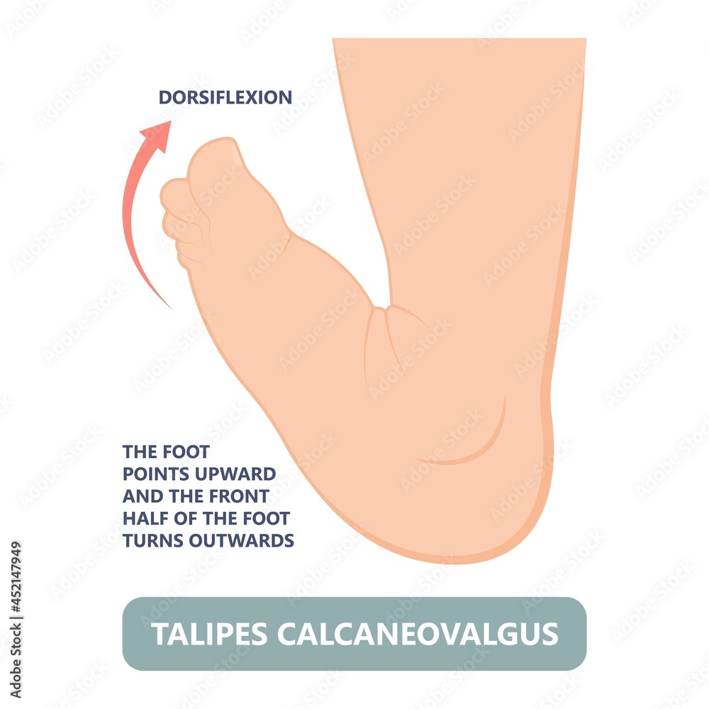 Newborn Foot Turned Inward at Micheal Weston blog