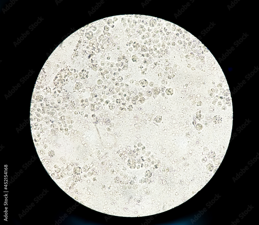 Urinary Tract Infection Microscopic Examination at Jonathan Baylee blog