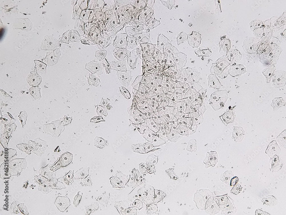 Epithelial cells with bacteria in patient urine (urinary tract ...