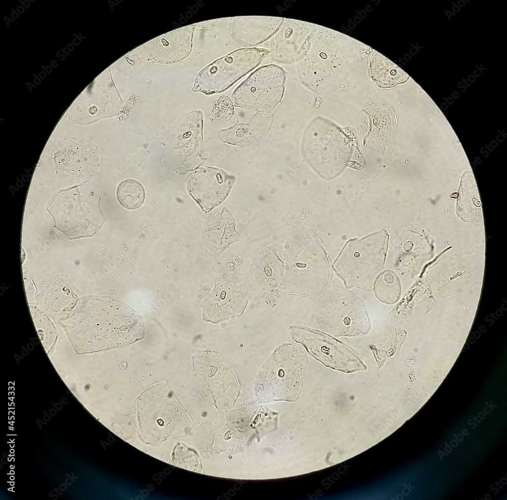 Epithelial cells with bacteria in patient urine (urinary tract ...