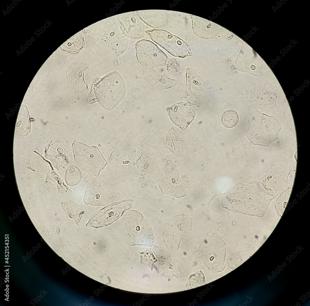 Epithelial cells with bacteria in patient urine (urinary tract ...