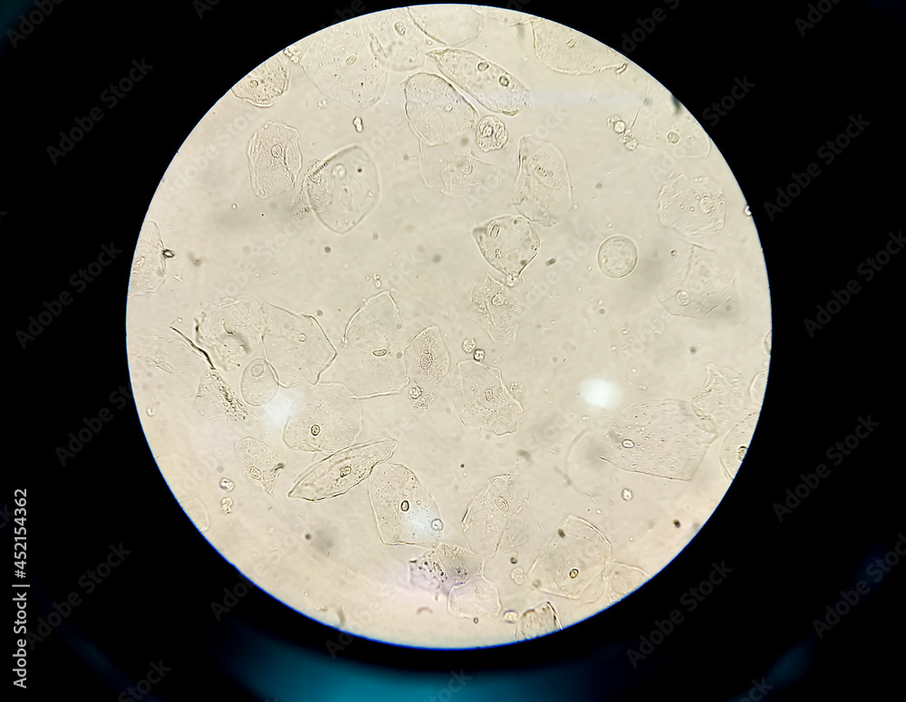 Epithelial cells with bacteria in patient urine (urinary tract ...