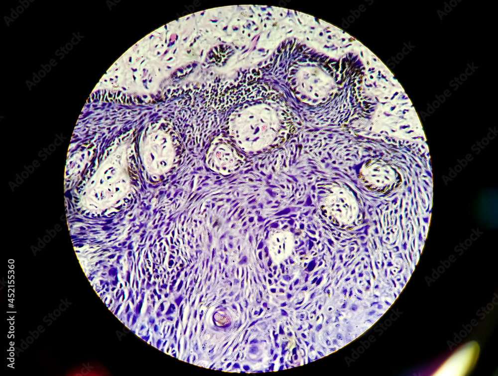 Fotka „Colon Cancer: Photomicrograph (microscopic image) of colonic ...