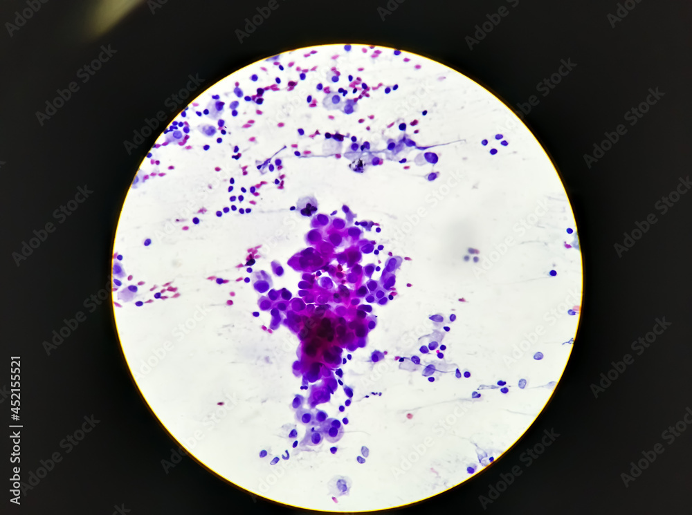 Foto de Liver SOL (CT guided FNA) microscopic 100x show positive for ...