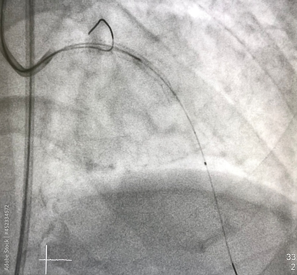 Intravascular ultrasound (IVUS) catheter advance to left anterior ...