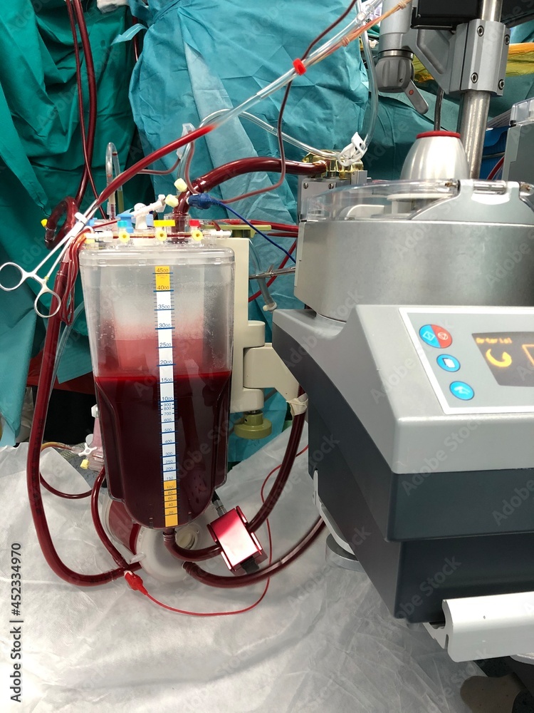 Venous reservoir and oxygenator connected with heart lung machine by ...