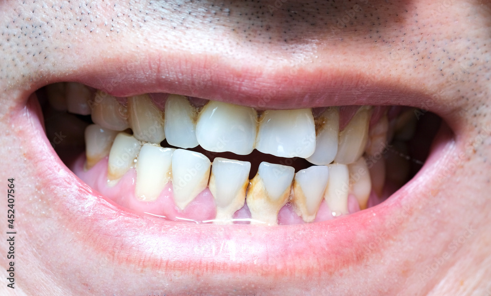 Tooth's a man smoking bad. Man smokes a cigarettes have tooth decay and ...