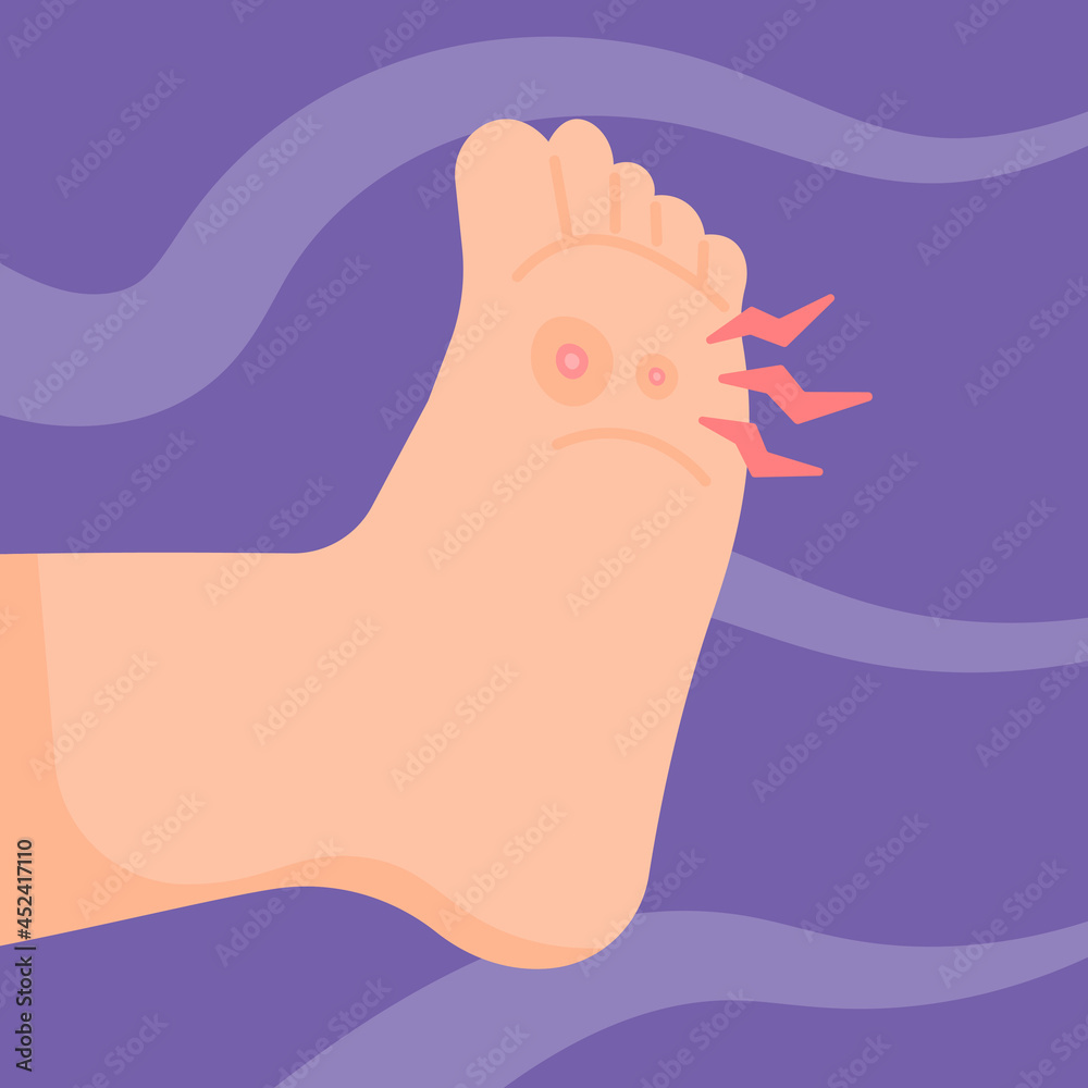 illustration of a foot affected by fish's eye disease or clavus. skin ...