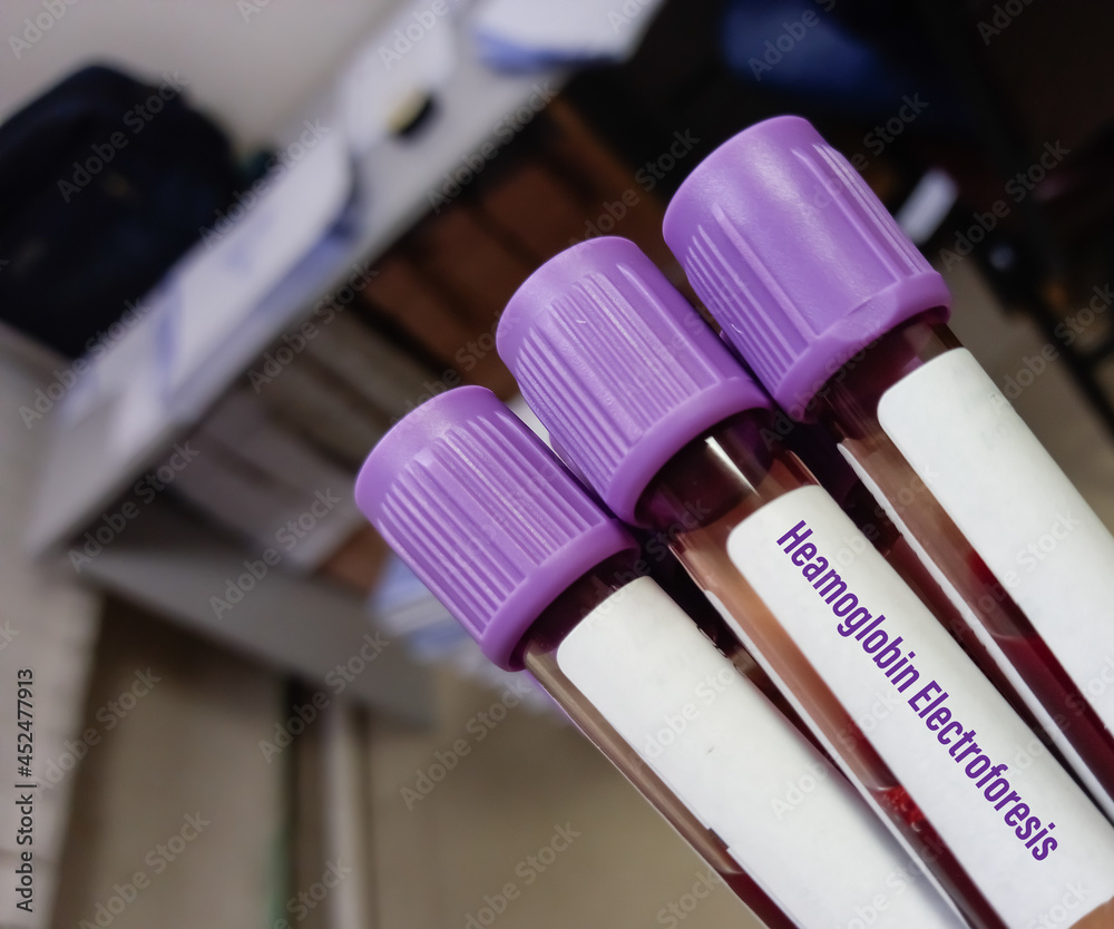 Blood sample for Hemoglobin Electrophoresis, diagnosis of Thalassemia ...