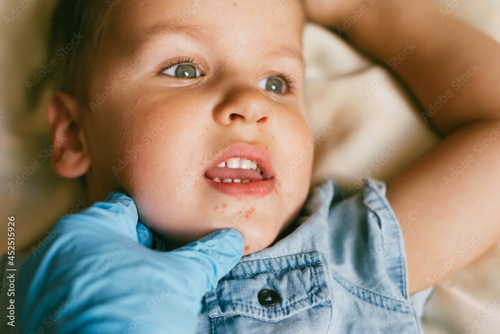 Rash of enterovirus infection picornavirus families on the face of a 3 ...