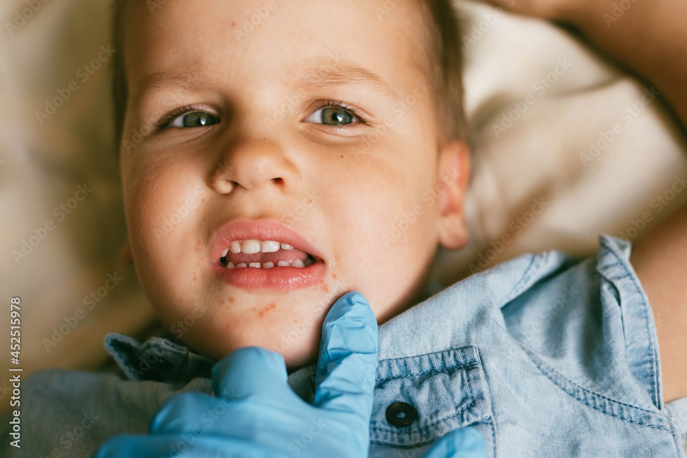 Rash of enterovirus infection picornavirus families on the face of a 3 ...