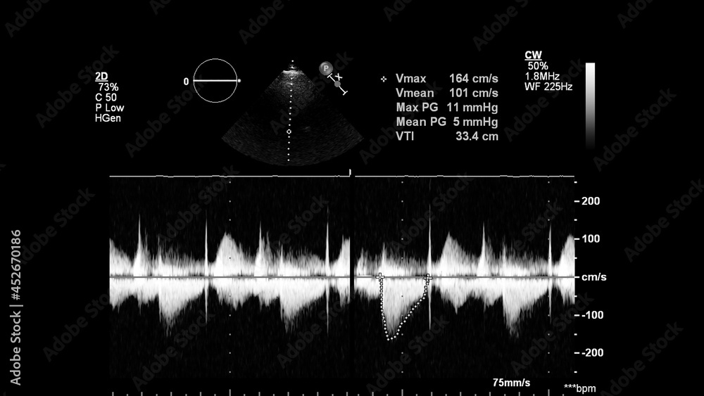 Image of the heart in gray-scale mode during transesophageal ultrasound ...