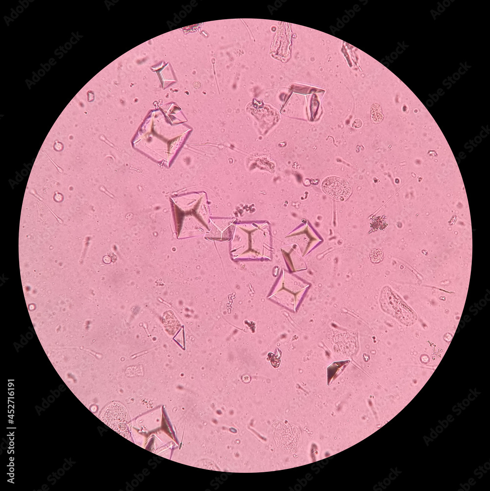 Urine sediment showing Struvite crystals, spermatozoa, RBC and squamous ...