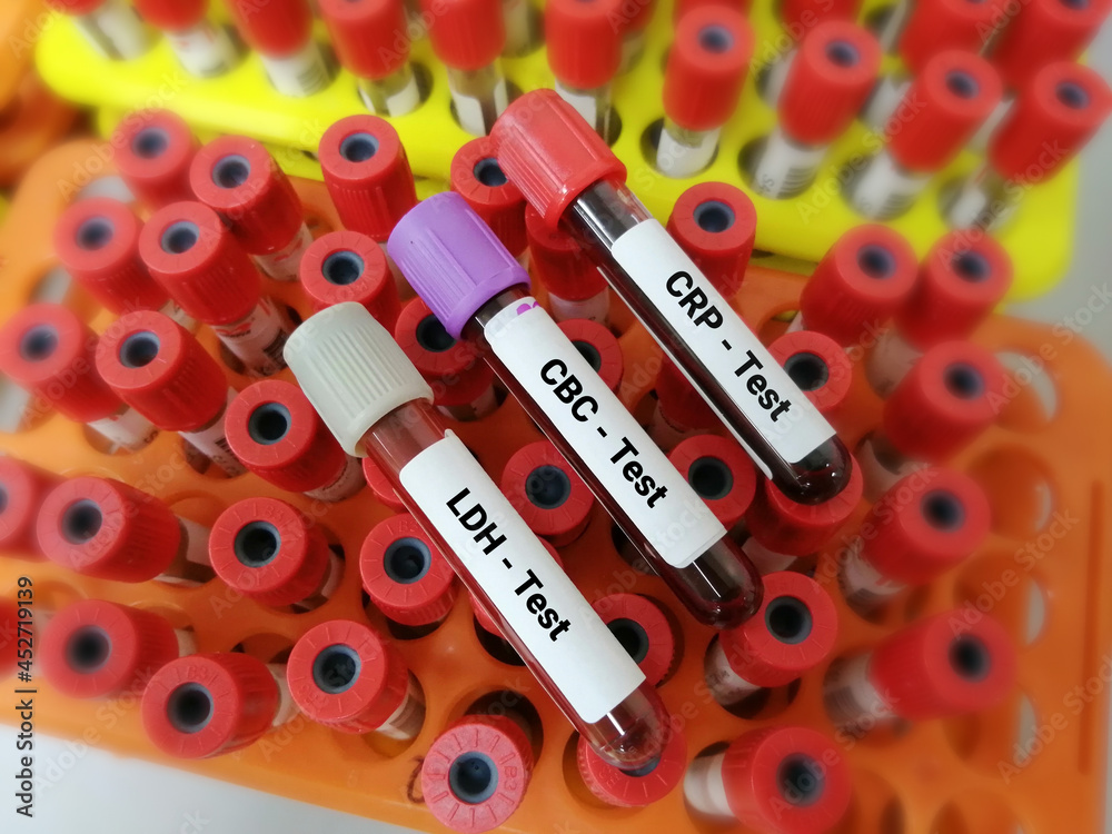 Blood samples isolated which is ready for laboratory analysis. LDH, CBC ...