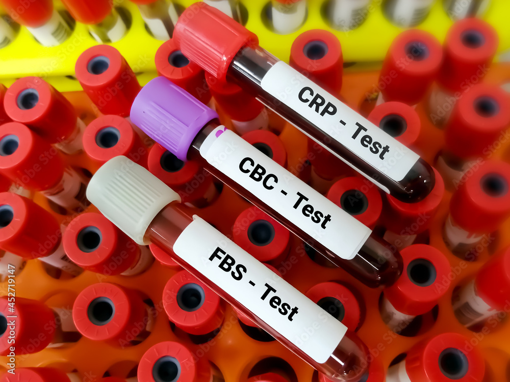 Blood samples isolated which is ready for laboratory analysis. FBS, CBC ...