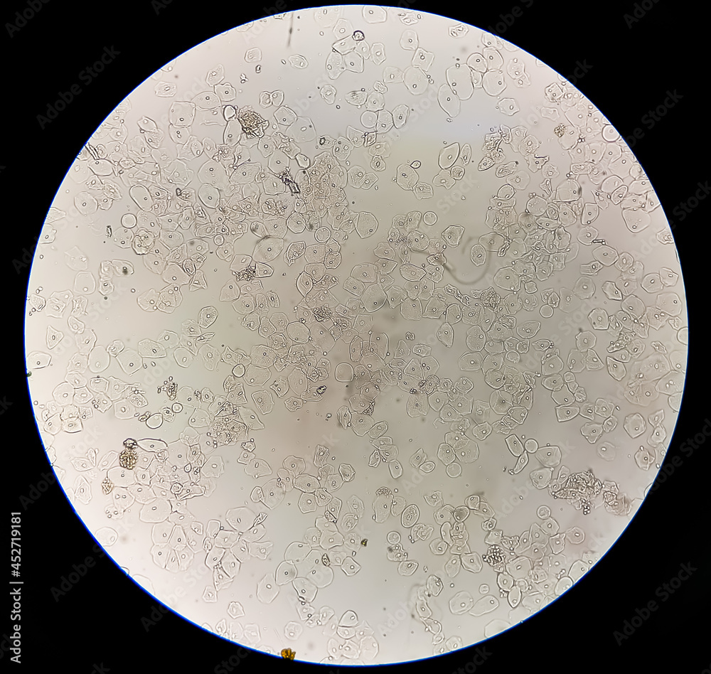 Abnormal result of urinalysis examination from microscopic method under ...