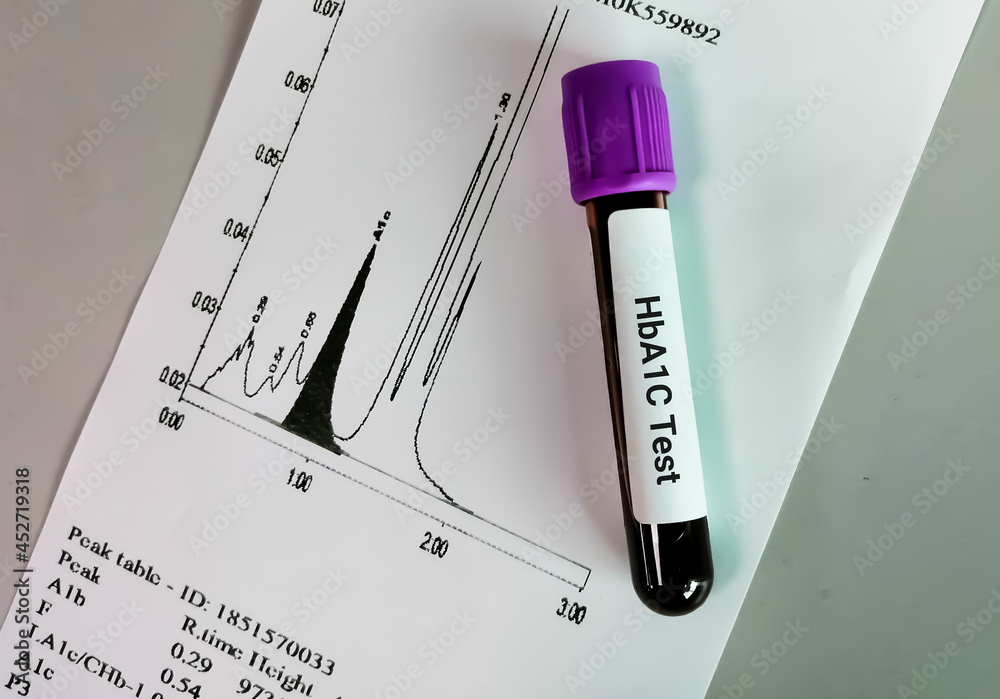 Blood sample for HbA1c (Hemoglobin A1c) test. Diabetic treatment ...