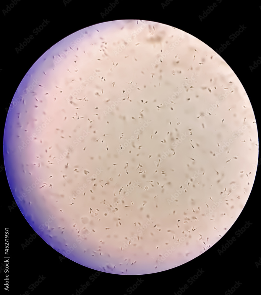 Sperm morphology. Semen photo under microscope. Micrograph showing ...