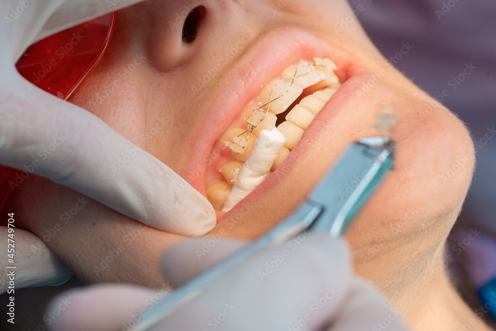 removing the brackets from the dental braces in process of removing ...