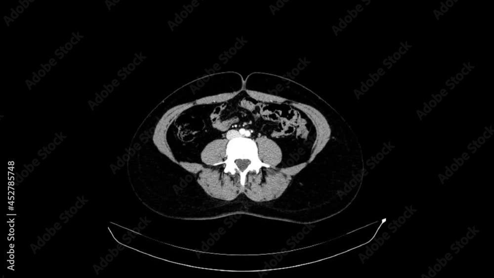 CT of the abdomen and pelvis with intravenous contrast of a 40-years ...