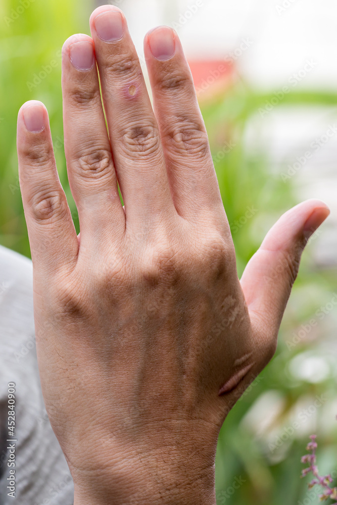 Paronychia, swollen finger inflammation due to bacterial infection on a ...
