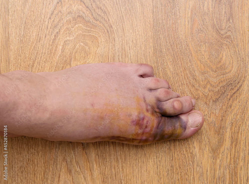 Swollen injured male limb on the left foot with hematoma when a heavy ...