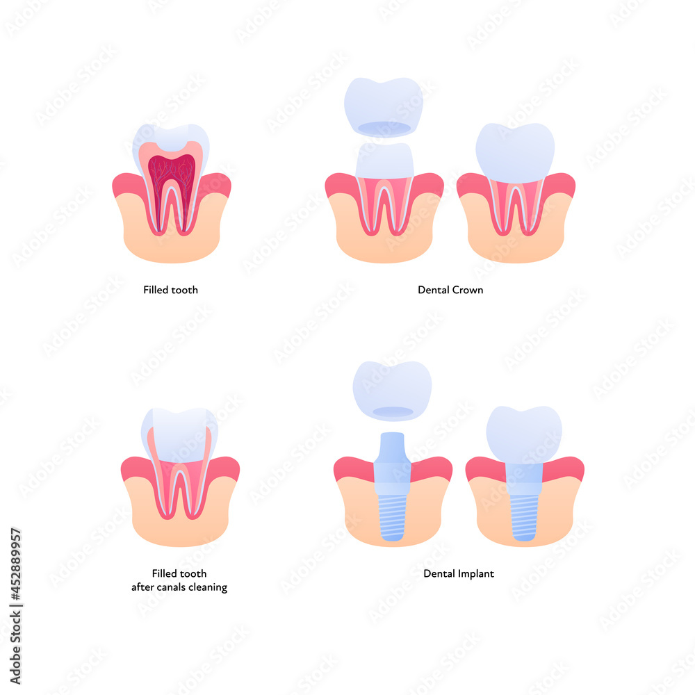 Tooth filling and implant chart. Vector biomedical illustration. Cross ...