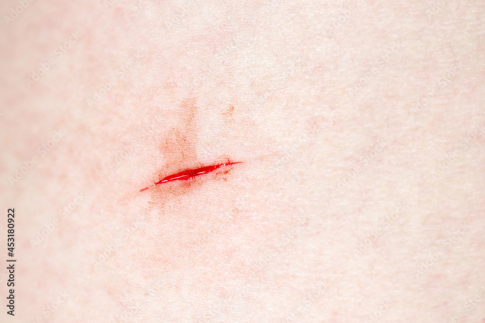 Cut on the body. Fresh wound on the leg with blood, skin texture. Woman ...