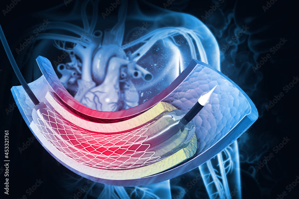 balloon angioplasty procedure with stent in vein.3d illustration Stock ...