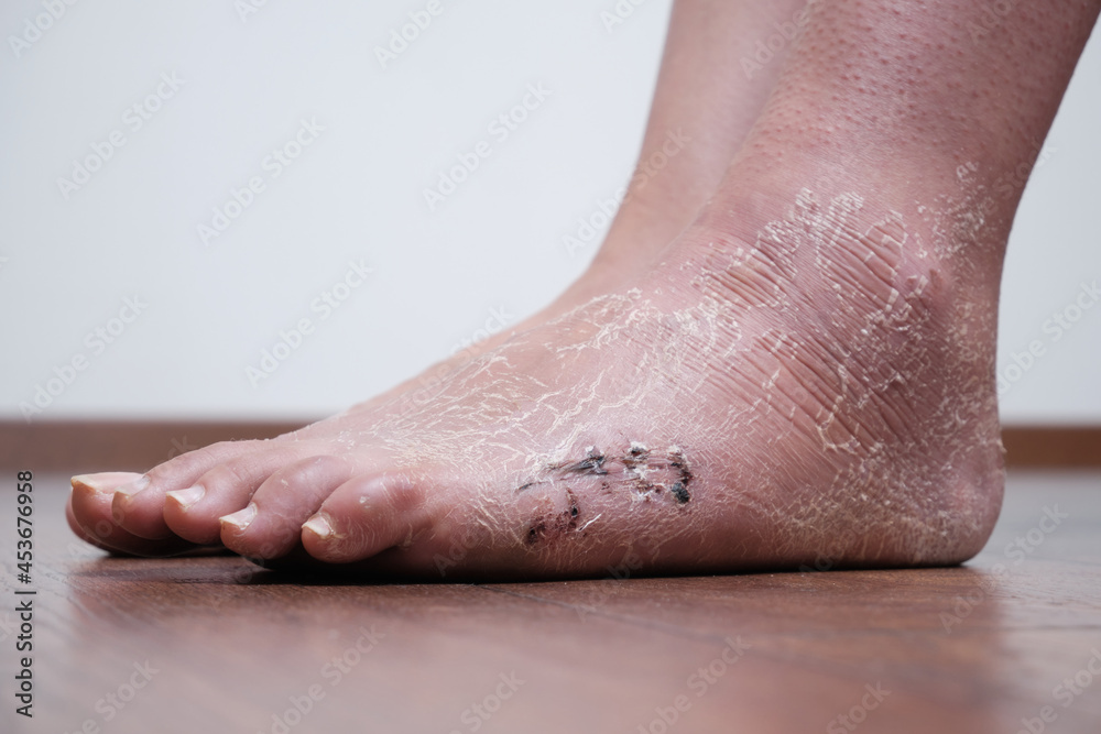 Postoperative suture on the foot, leg after fracture and after removal ...