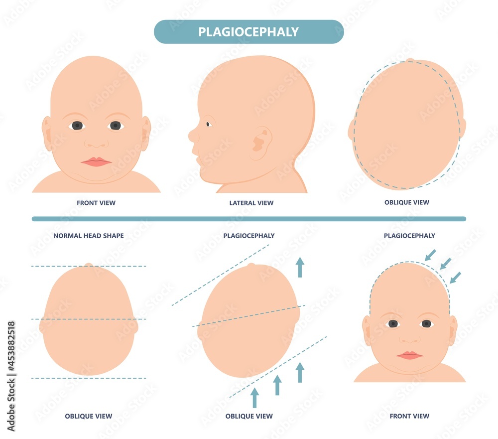 craniosynostosis helmet pillow flat head autism brain skull bone ...