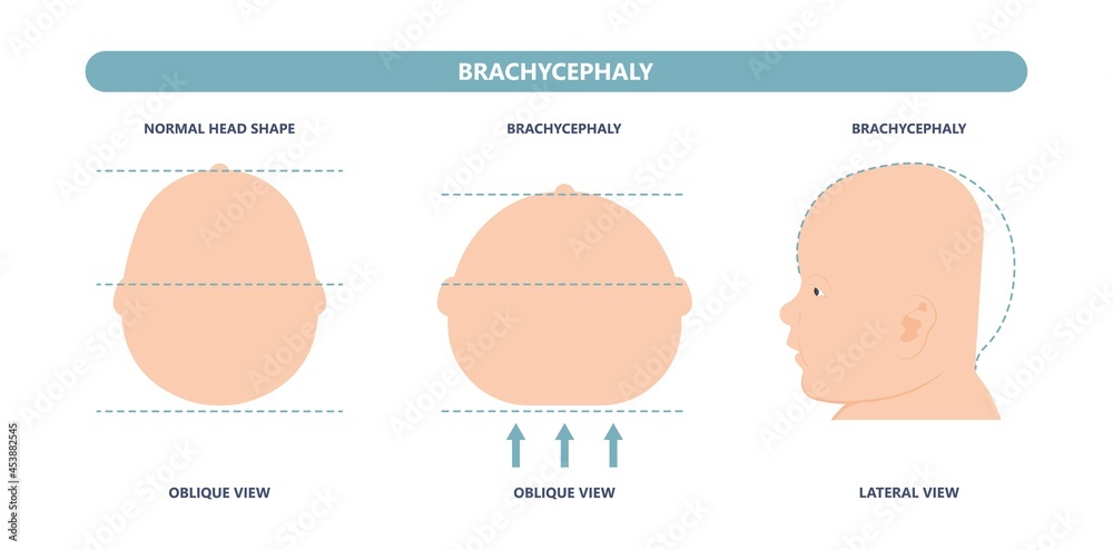 craniosynostosis helmet pillow flat head autism brain skull bone ...