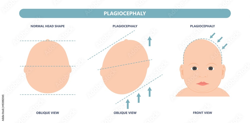 craniosynostosis helmet pillow flat head autism brain skull bone ...