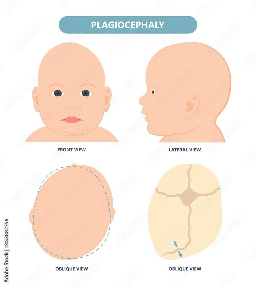 craniosynostosis helmet pillow flat head autism brain skull bone ...