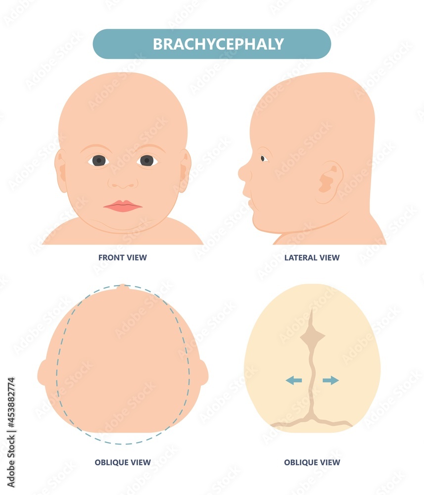 craniosynostosis helmet pillow flat head autism brain skull bone ...