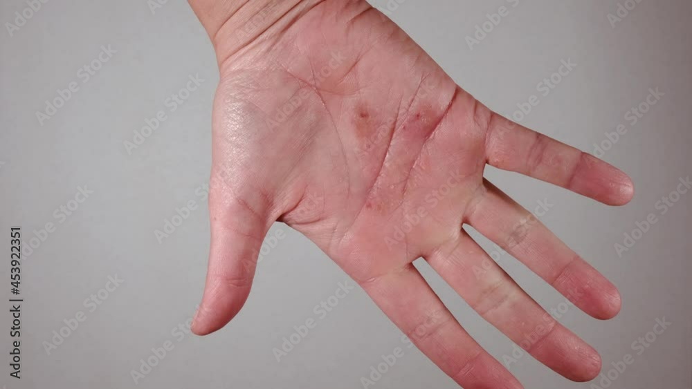 Close-up view of cracked dry skin of palm. Woman shows her hand with ...
