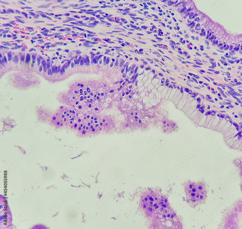 Camera photo of adenocarcinoma in situ (AIS) of cervix, magnification ...