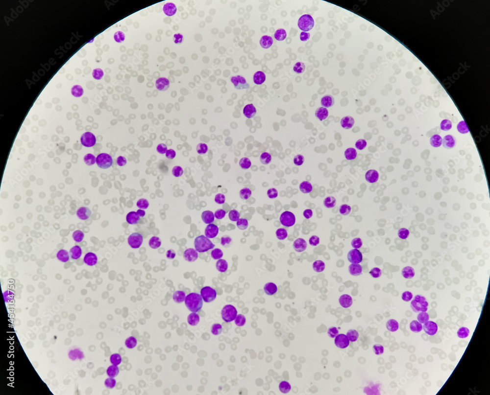 Chronic myeloid leukemia (CML). Red blood cell. Blood smear microscopic ...