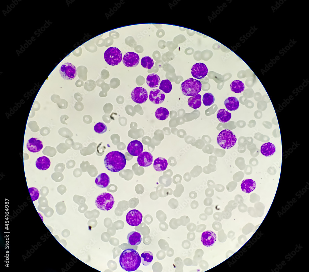 Acute myeloid leukemia (AML) is a type of blood cancer. Microscopic ...