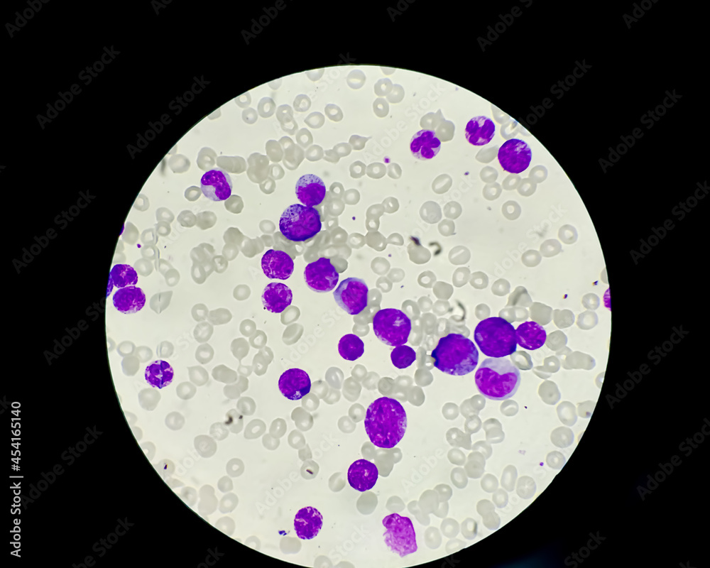 Acute myeloid leukemia (AML) is a type of blood cancer. Microscopic ...