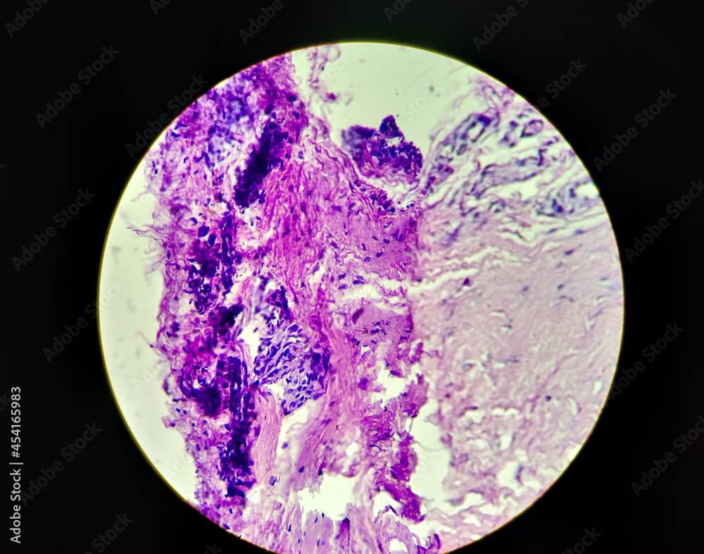 Leiomyoma, or fibroids, is a smooth muscle benign tumors, light ...