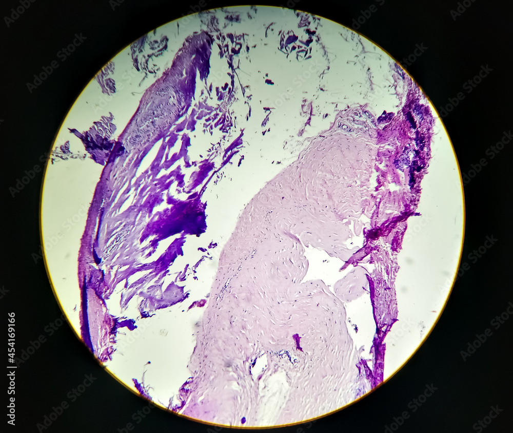 Lobular Capillary hemangioma, light micrograph, photo under 400x ...
