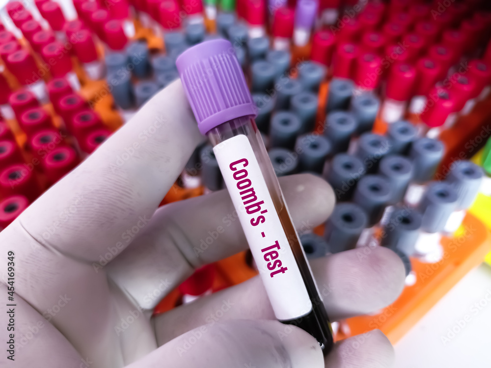 Blood tube sample for coomb's test for autoimmune hemolytic anemia ...