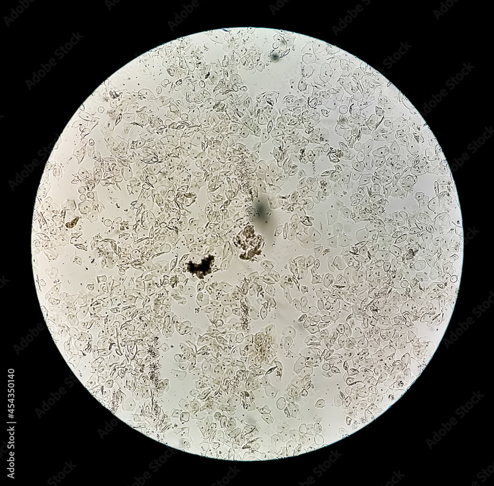 Foto de Abnormal result of urinalysis examination from microscopic ...