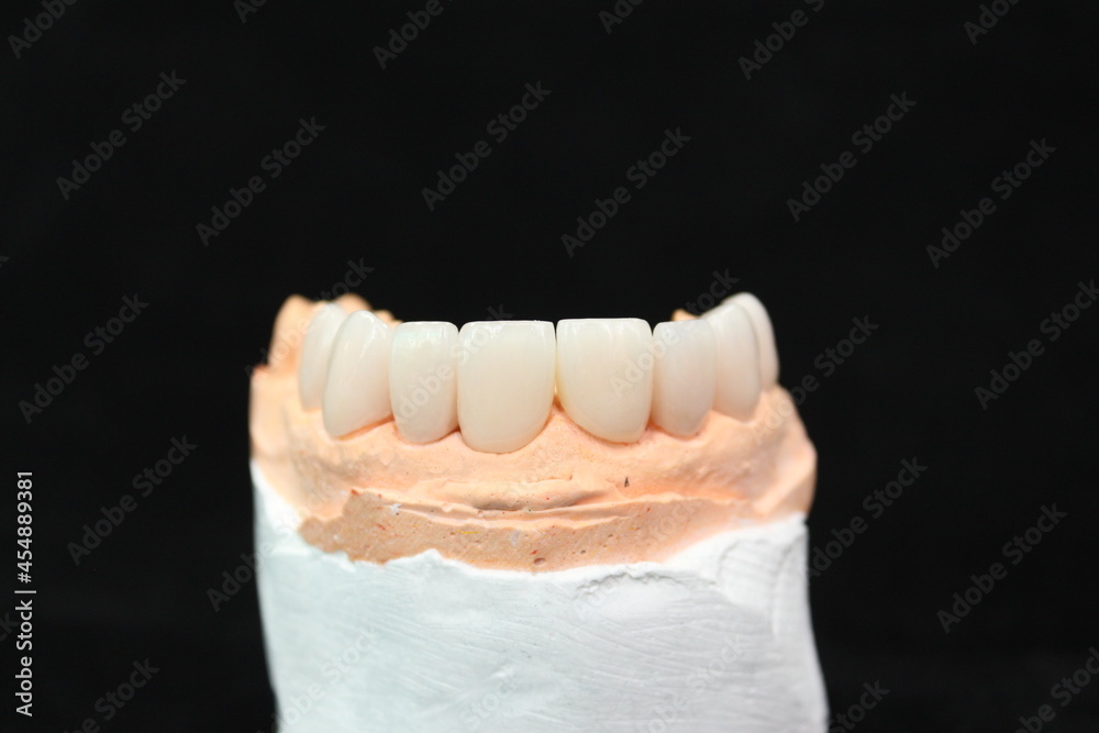 Dental crowns in the plaster model for treatment and new smile Stock 写真 ...