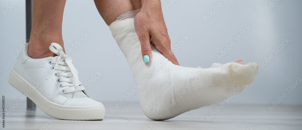 Close-up of female legs with plaster cast. A woman with a broken leg ...