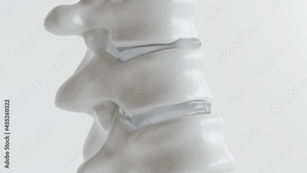 Poster Spinal disc herniation as close-up as 3D Rendering – Wall Art ...