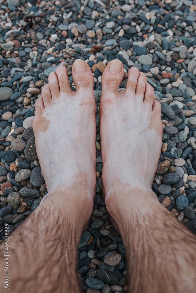 Male feet with skin pigmentation and spots on a beach pebble background ...