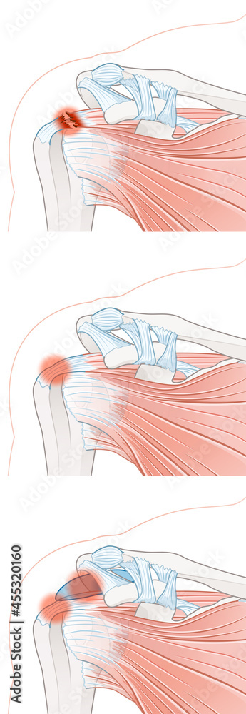 Shoulder pain. Rotator cuff tear, rotator cuff tendonitis, shoulder ...